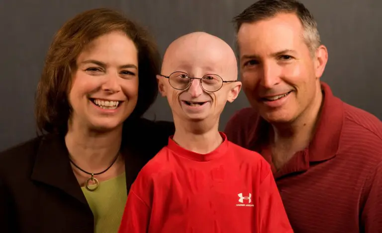 Progeria (sindrome di Benjamin Button): diagnosi, terapie e aspettativa ...