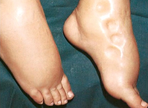 Differenza tra edema localizzato, generalizzato e sistemico | MEDICINA ...