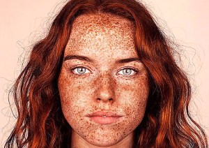 Qual è la differenza tra lentiggini ed efelidi? | MEDICINA ONLINE