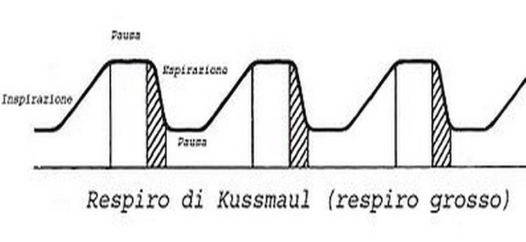 Respiro di Kussmaul: caratteristiche e cause | MEDICINA ONLINE