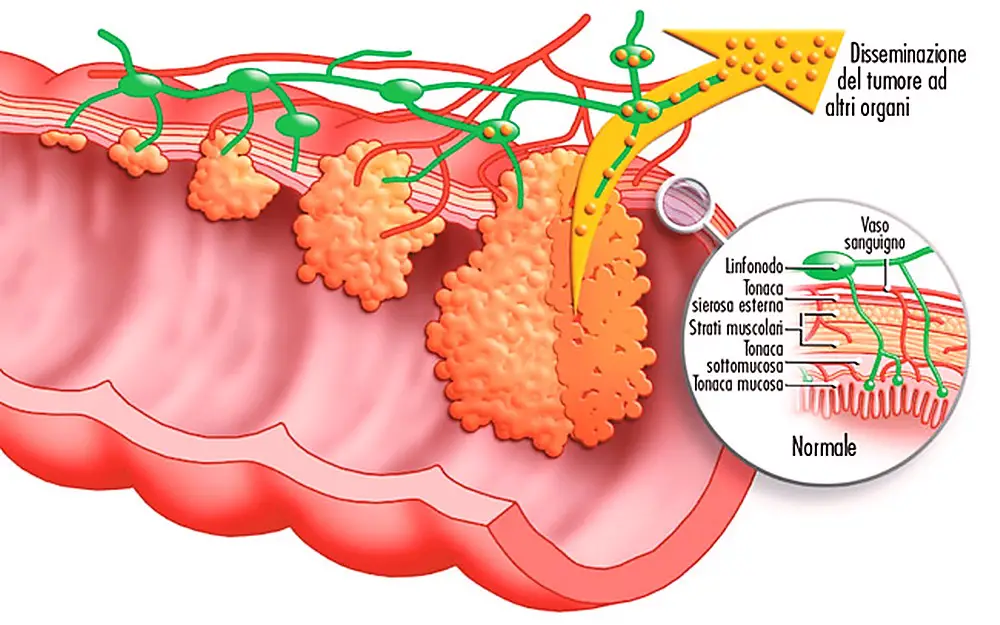 Tumore del colon retto: diagnosi, metastasi, prognosi e stadiazione ...