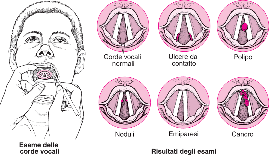 Polipi Noduli E Granulomi Delle Corde Vocali Cause Sintomi E Cure