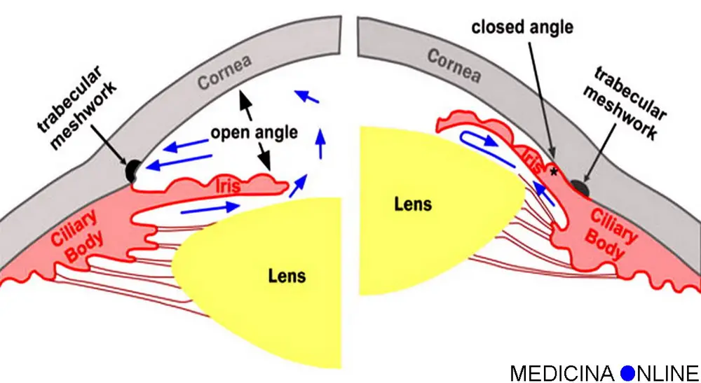 Differenza tra glaucoma angolo aperto e chiuso | MEDICINA ONLINE
