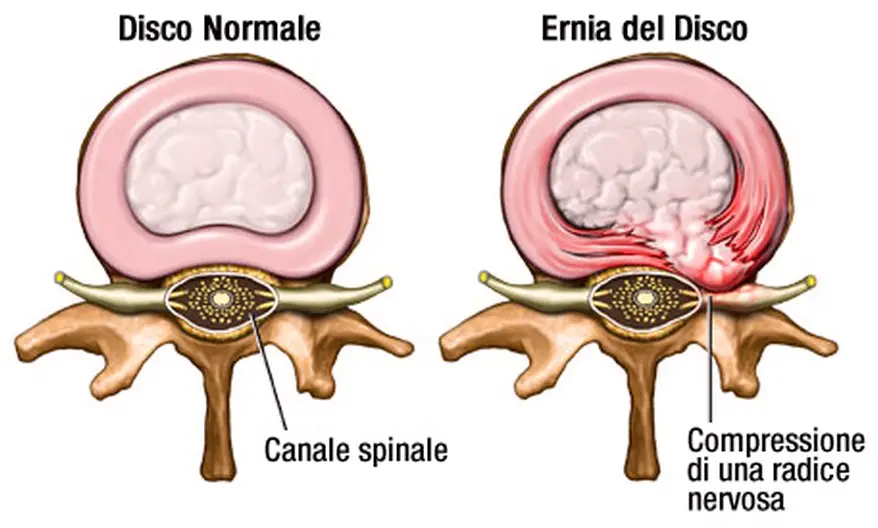 Discopatia degenerativa lombare e cervicale: cura, esercizi ...