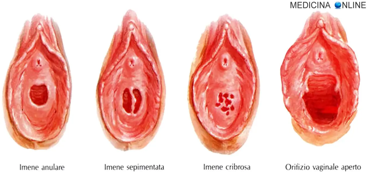Imenotomia (imenectomia): l’incisione chirurgica dell’imene | MEDICINA ONLINE