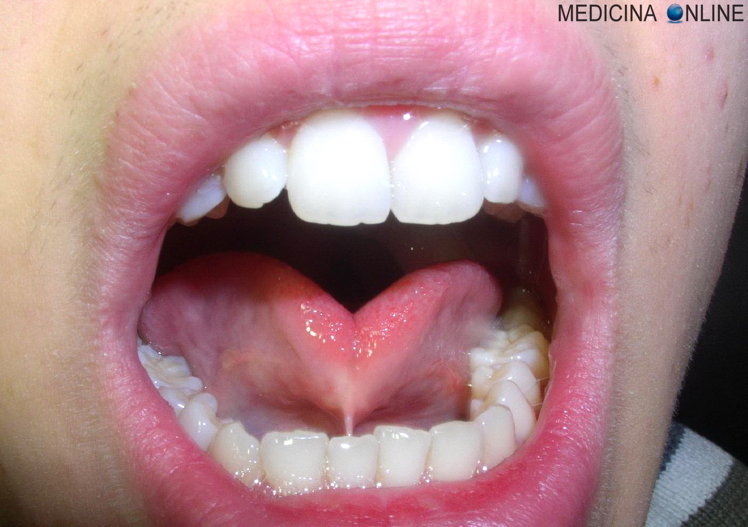 Papille gustative ingrossate: quando la lingua è infiammata | MEDICINA ...