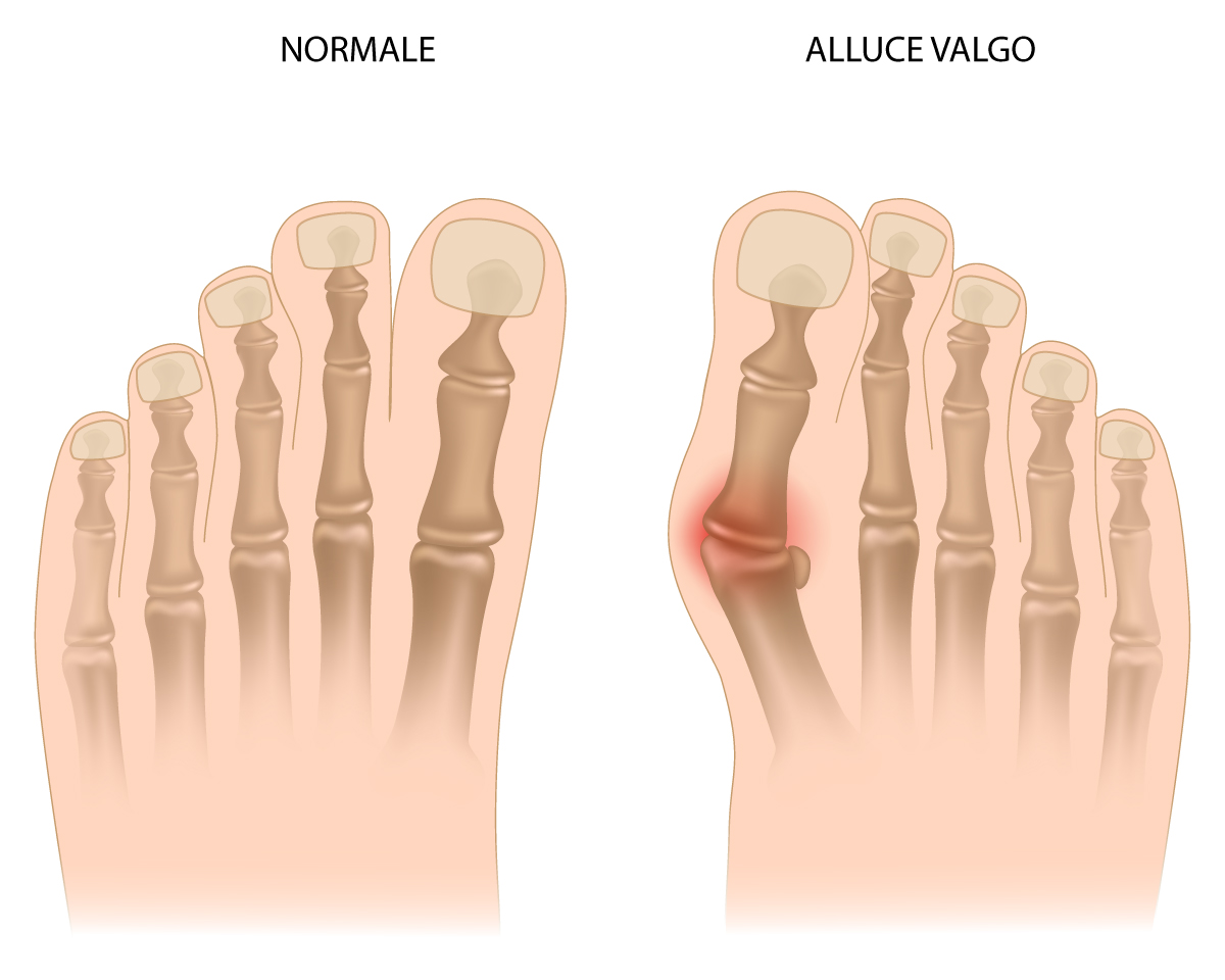 alluce valgo | MEDICINA ONLINE