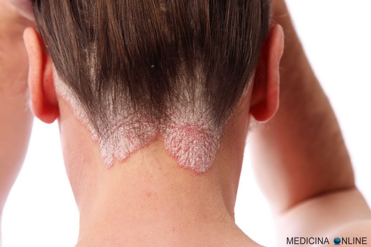 dermatite seborroica | MEDICINA ONLINE