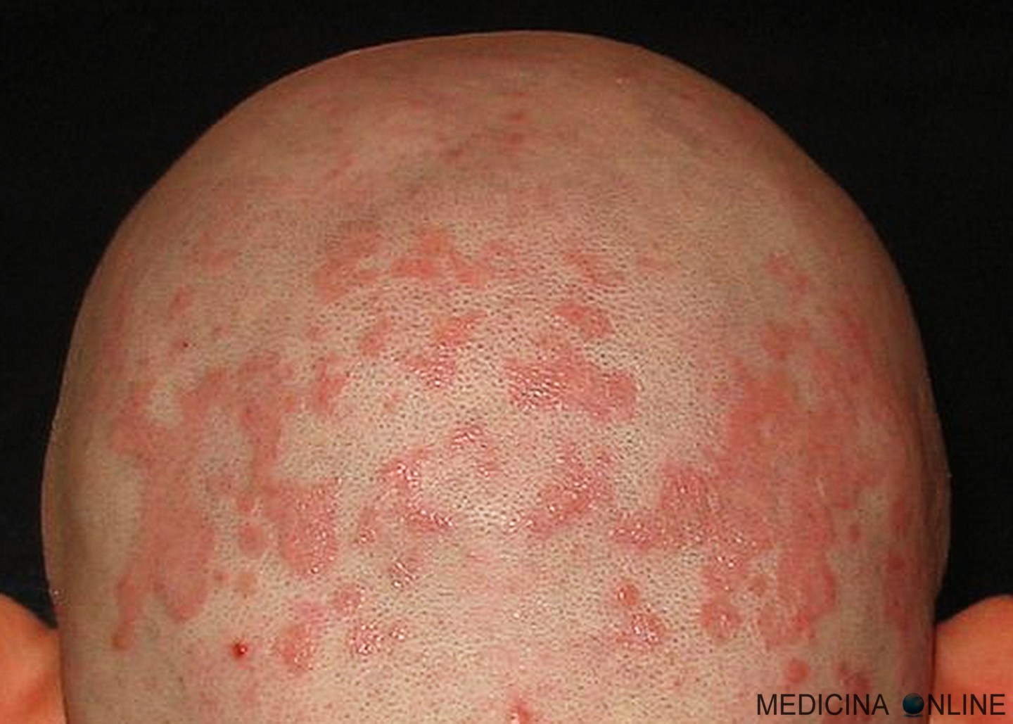Differenza tra alopecia e dermatite seborroica | MEDICINA ONLINE