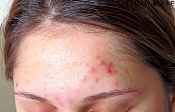 Dermatite seborroica: cause, immagini, cure, rimedi naturali, crema e ...