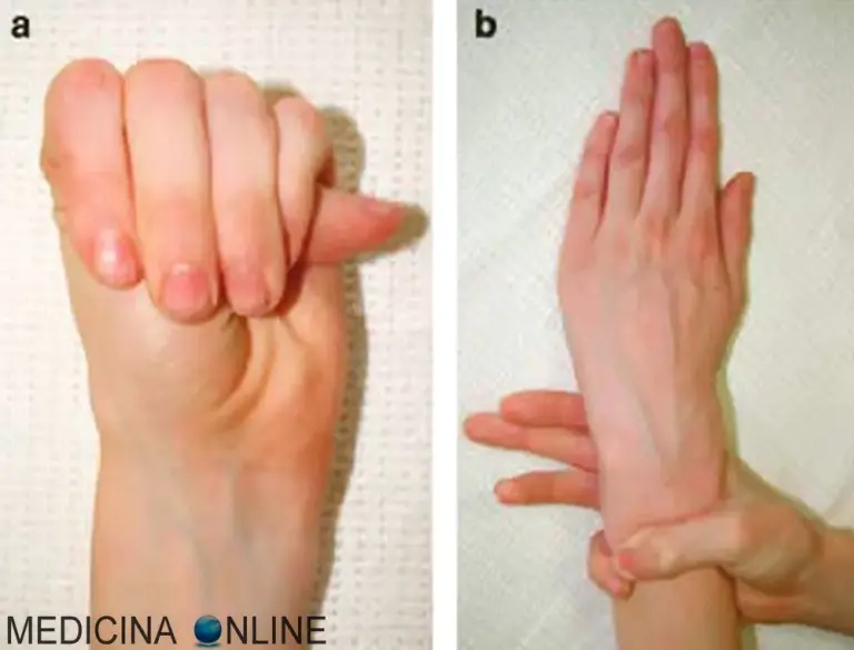 Aracnodattilia, segno del pollice e del polso, Sindrome di Marfan e di ...