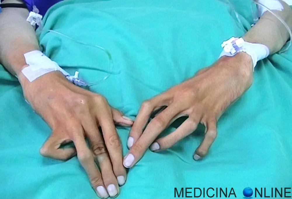 Sindrome Di Marfan Mani Niccolò Paganini, Le Mani Di Un Genio