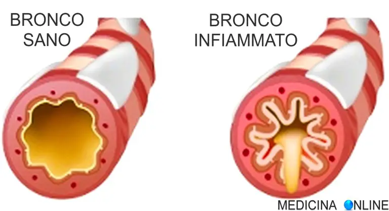 Bronchite: durata, sintomi, cura, rimedi, è contagiosa? Per quanto ...