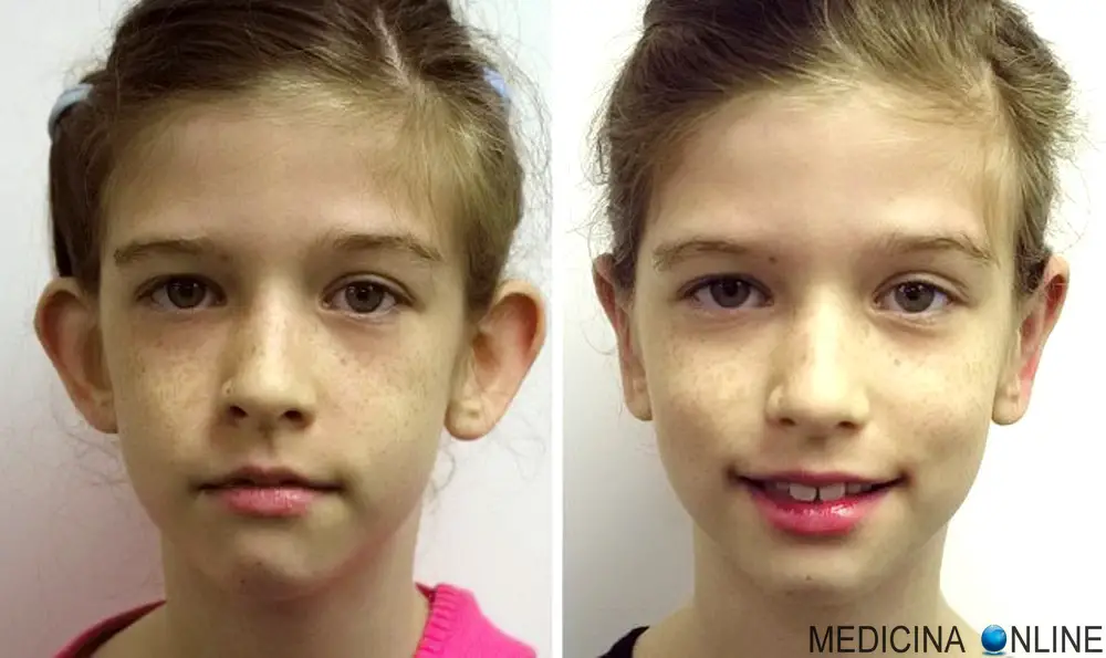 Orecchie a sventola: rimedi naturali per adulti e bimbi senza ...