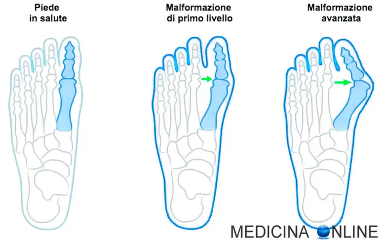 Alluce valgo: sintomi iniziali, dolore, correttore, esercizi e ...