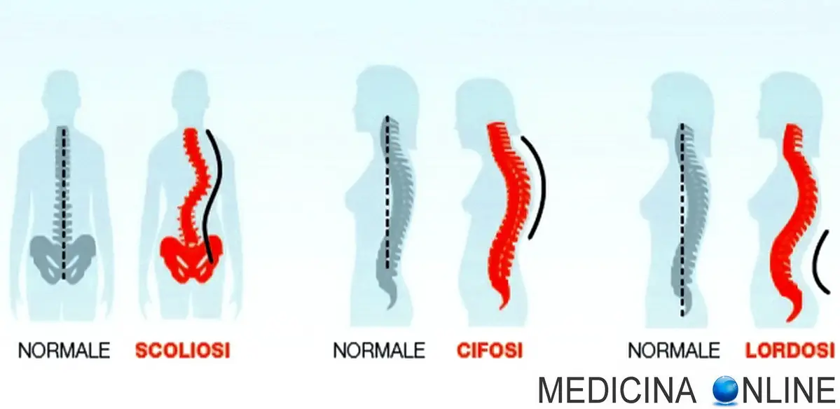 Differenza tra scoliosi, cifosi e lordosi normale e patologica ...