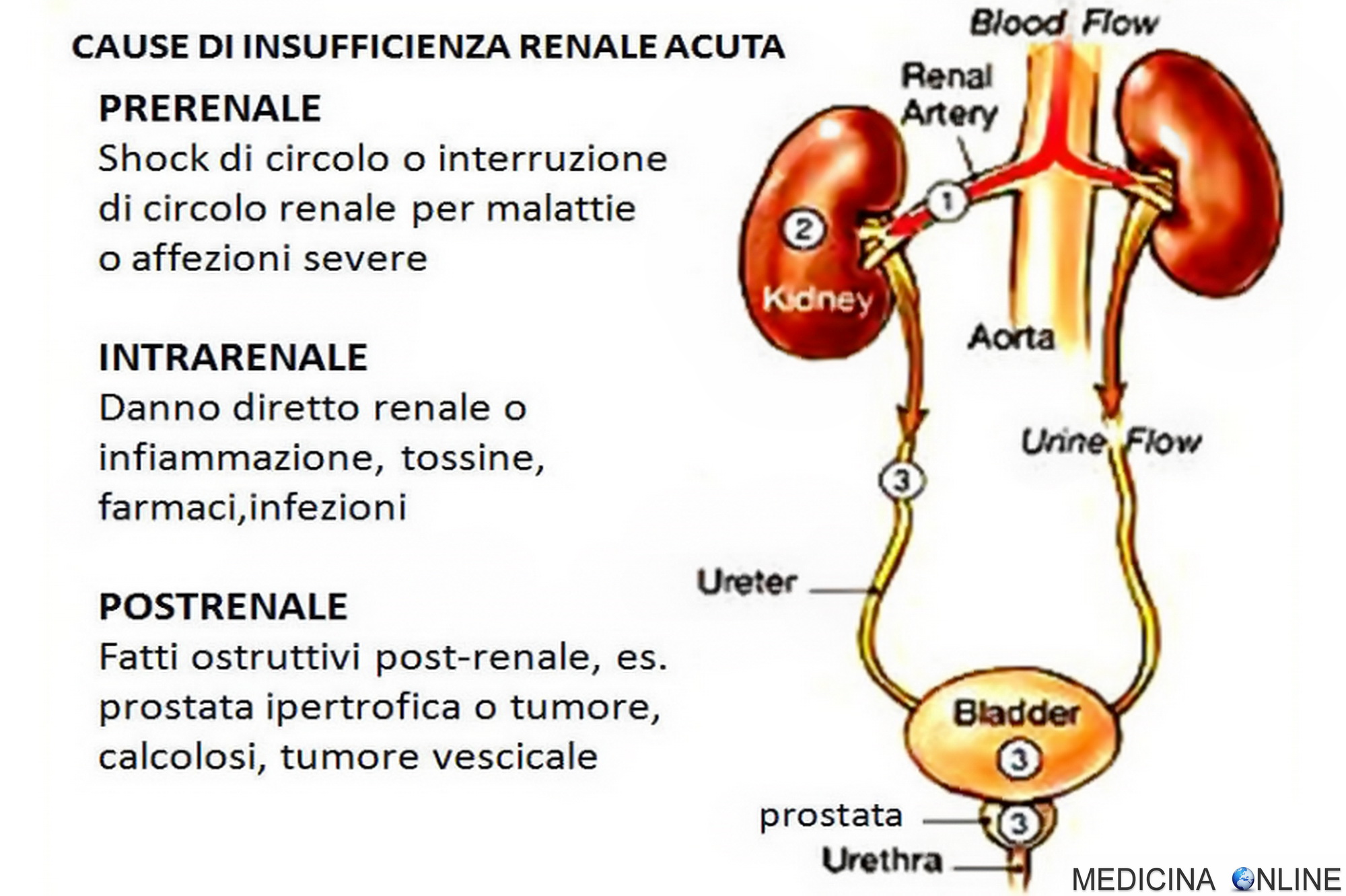 Insufficienza renale acuta: sintomi, terapia, linea guida, morte ...