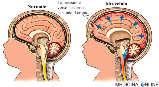 Ecografia Macrocefalia