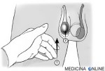 Riflesso cremasterico del testicolo: accentuato e assente | MEDICINA ONLINE