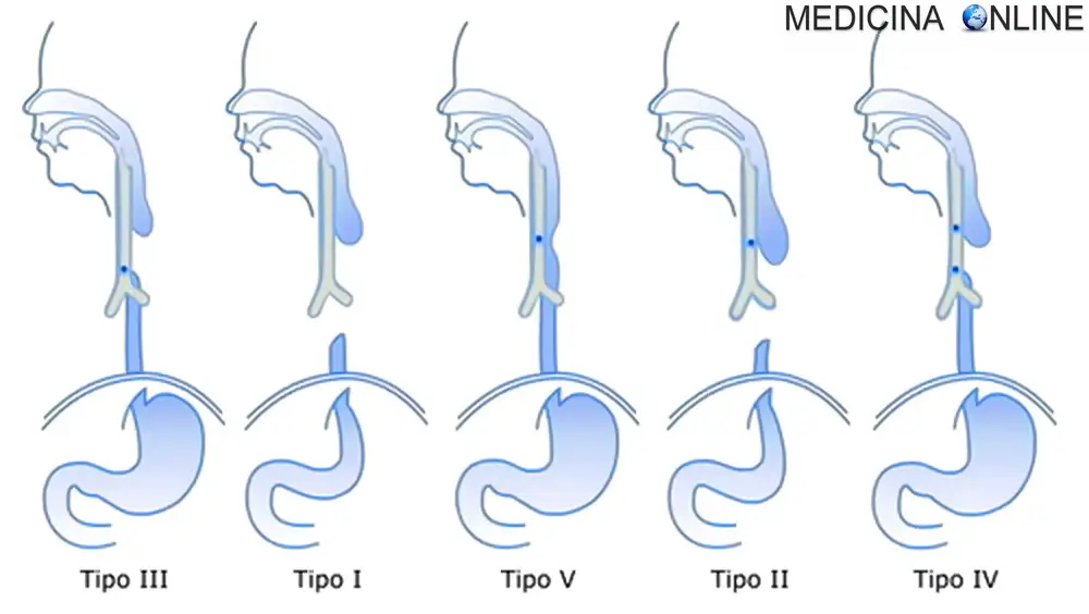 Atresia esofagea: conseguenze, intervento, sintomi, classificazione ...