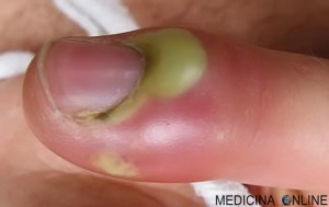 Patereccio: significato, tipi, come si cura, incisione | MEDICINA ONLINE