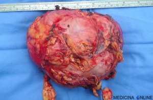 Surrenectomia: tecniche e conseguenze dell’asportazione del surrene ...