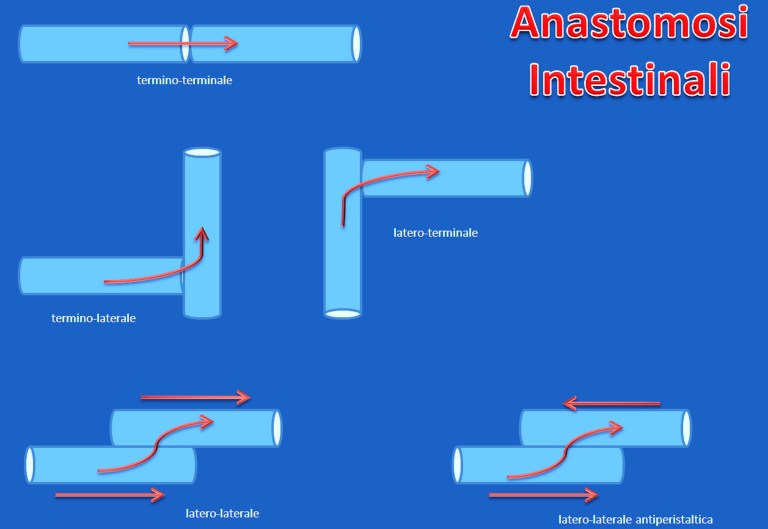 Anastomosi chirurgiche terminali e laterali: tipi e differenze ...