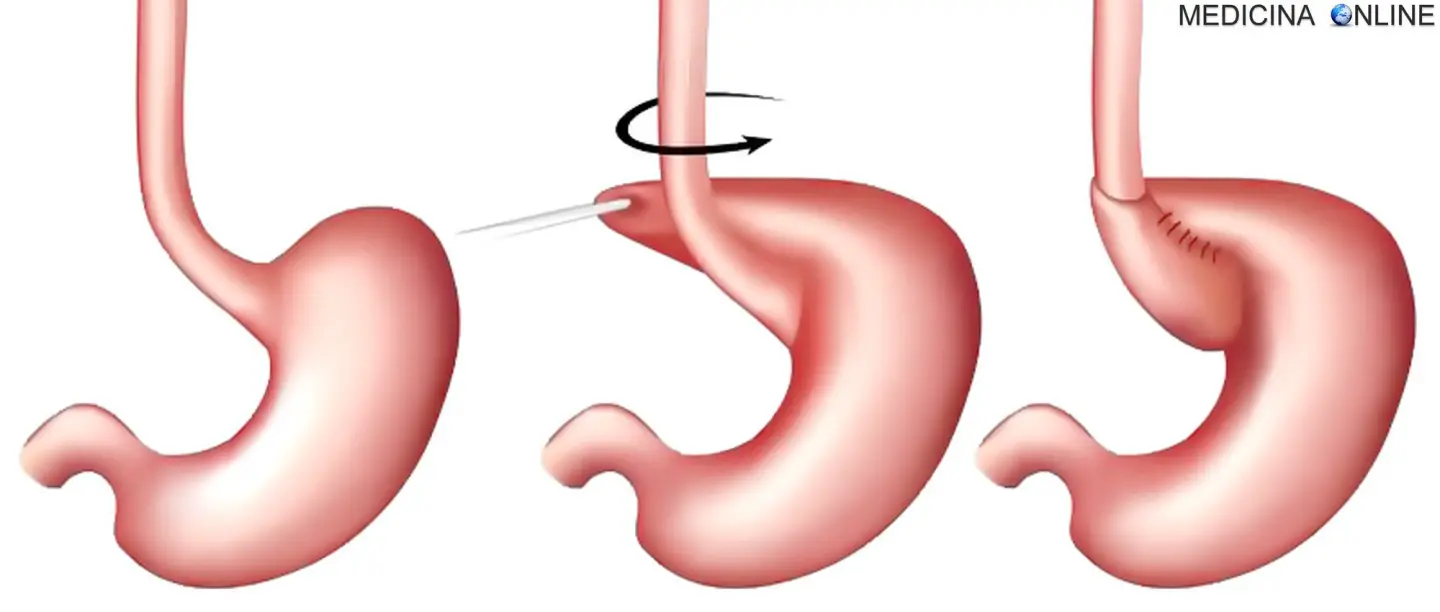 Fundoplicatio secondo Nissen-Rossetti: intervento e rischi | MEDICINA ...