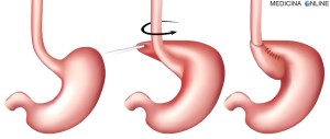 Fundoplicatio secondo Nissen-Rossetti: intervento e rischi | MEDICINA ...