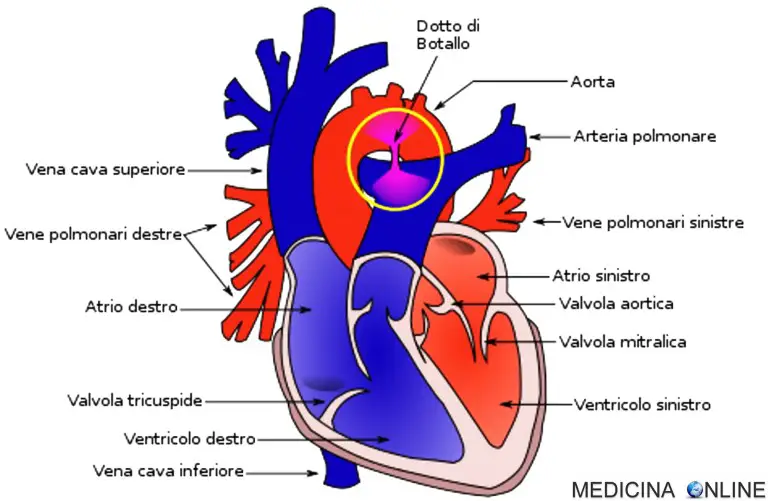 Pervietà del dotto di Botallo: cause, sintomi, diagnosi, terapia ...