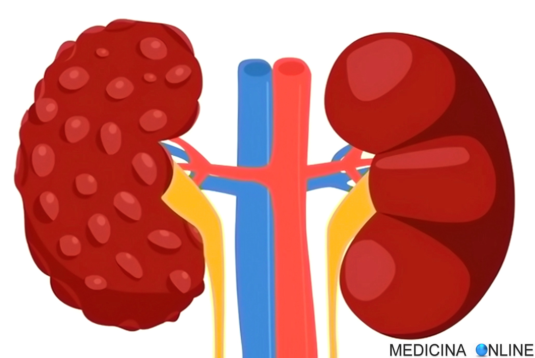 Cisti parapieliche (cisti renali semplici): cause, sintomi, quando ...