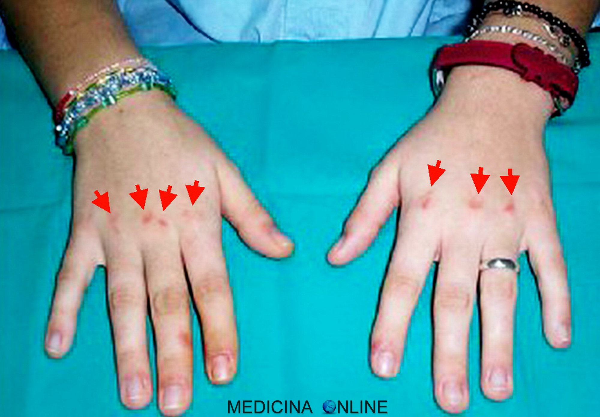 segno di Russell | MEDICINA ONLINE