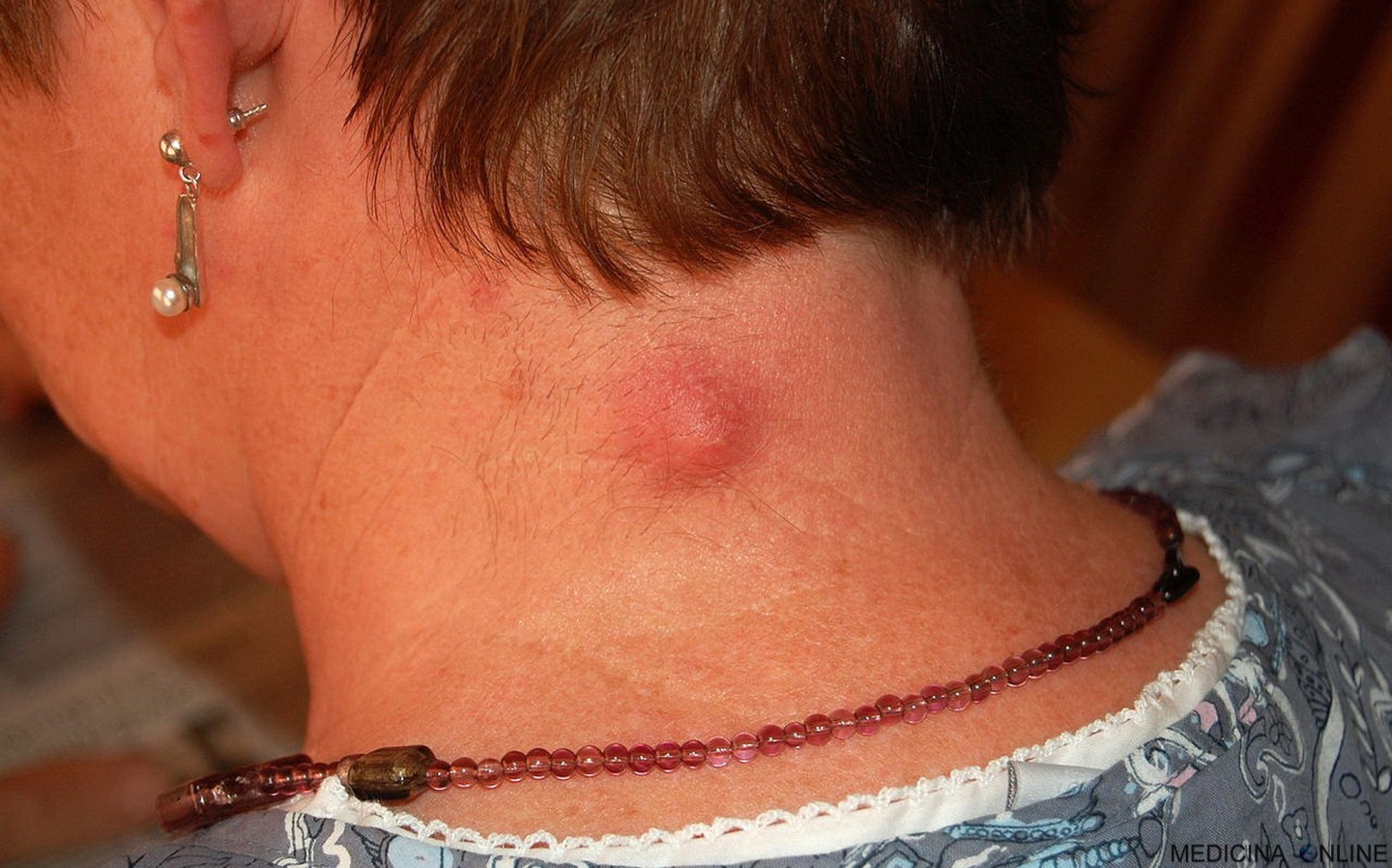 Cisti sebacea: cause, caratteristiche, riassorbimento, cure ...