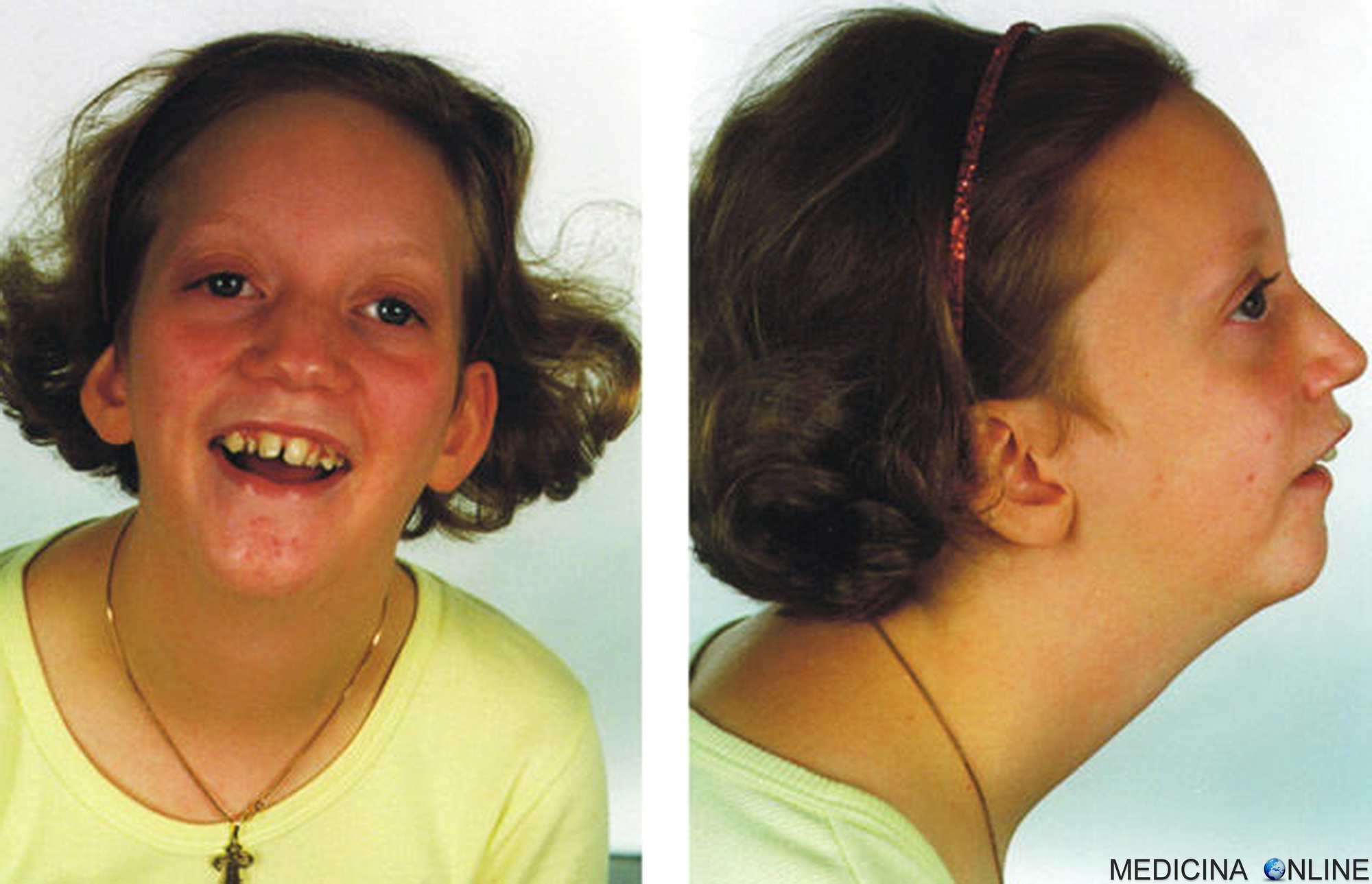 Sindrome di Pierre Robin: cause, sintomi, diagnosi, cure, prognosi ...