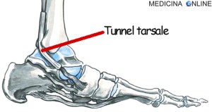Sindrome del tunnel tarsale: cause, sintomi, diagnosi e terapia ...