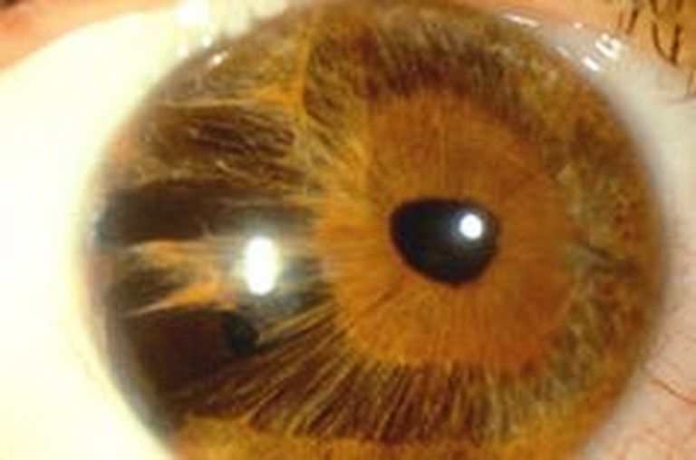 Corectopia: quando la pupilla dell’occhio non è al centro dell’iride ...