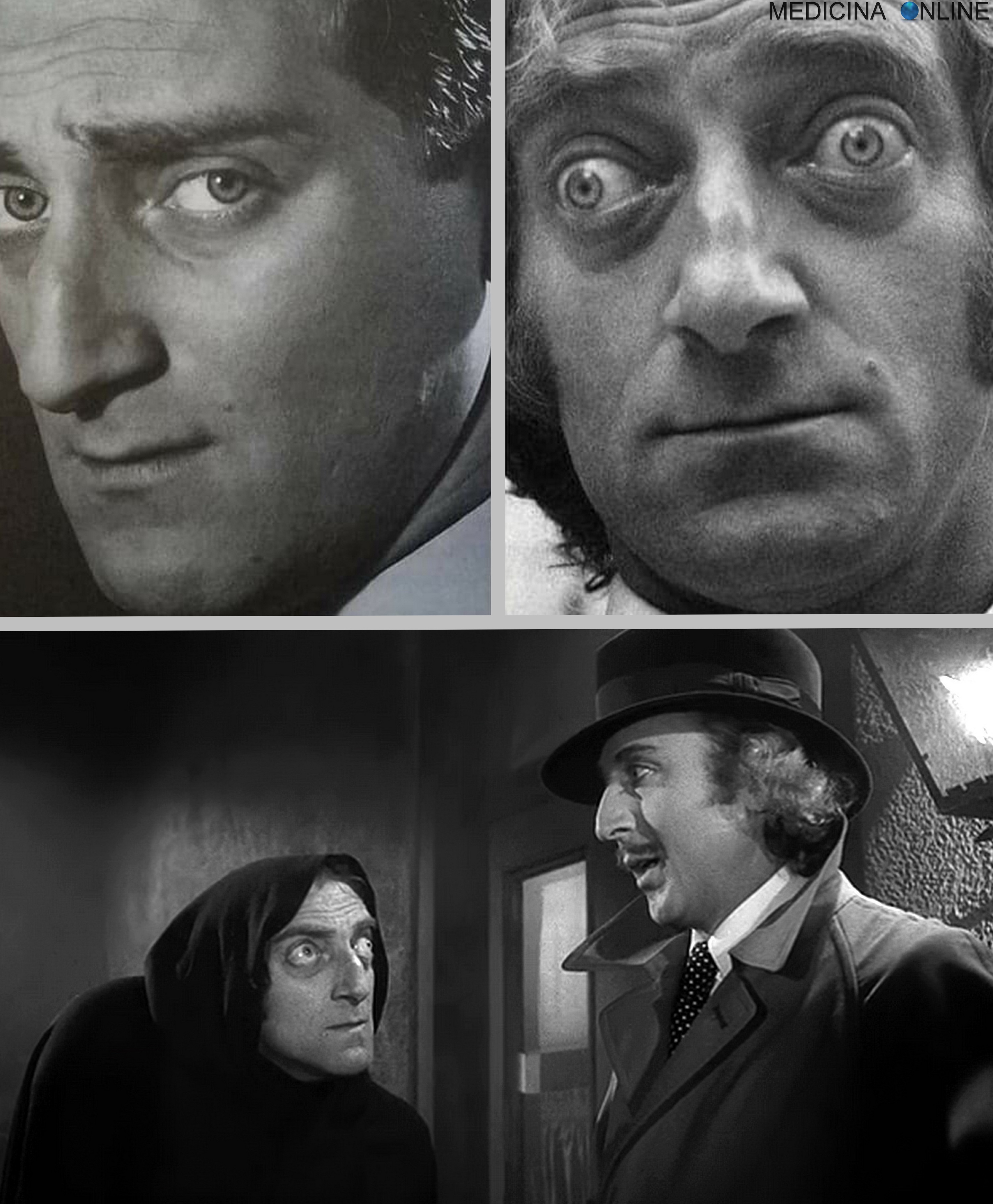 strabismo divergente | MEDICINA ONLINE