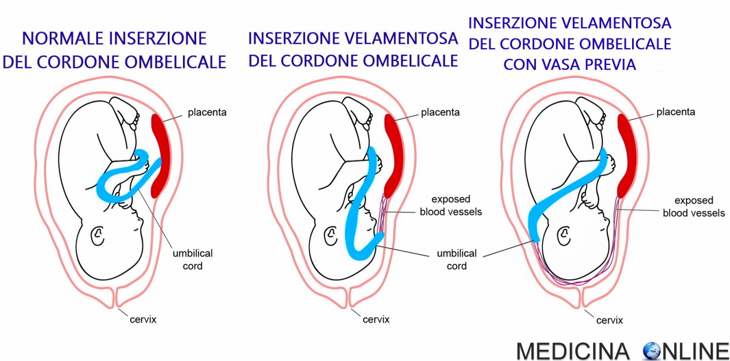 Inserzione velamentosa del cordone ombelicale: cause, sintomi, cure ...
