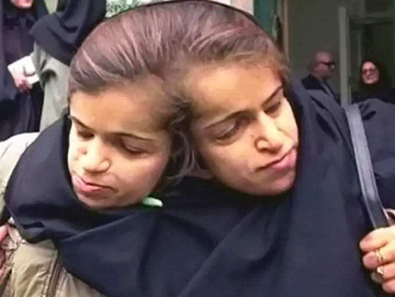Ladan e Laleh Bijani, le gemelle siamesi iraniane morte durante l ...