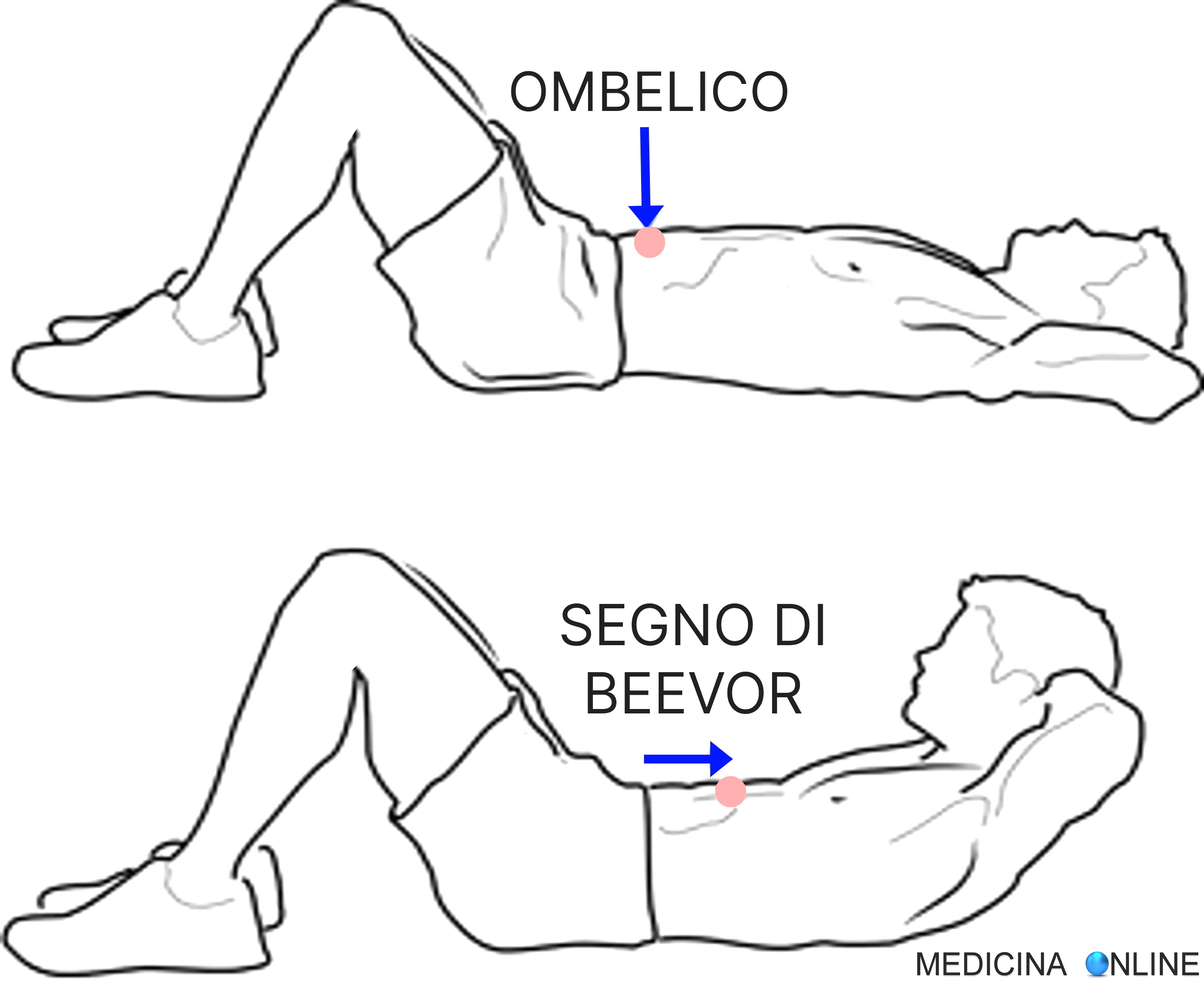 Segno di Beevor positivo e negativo: significato | MEDICINA ONLINE