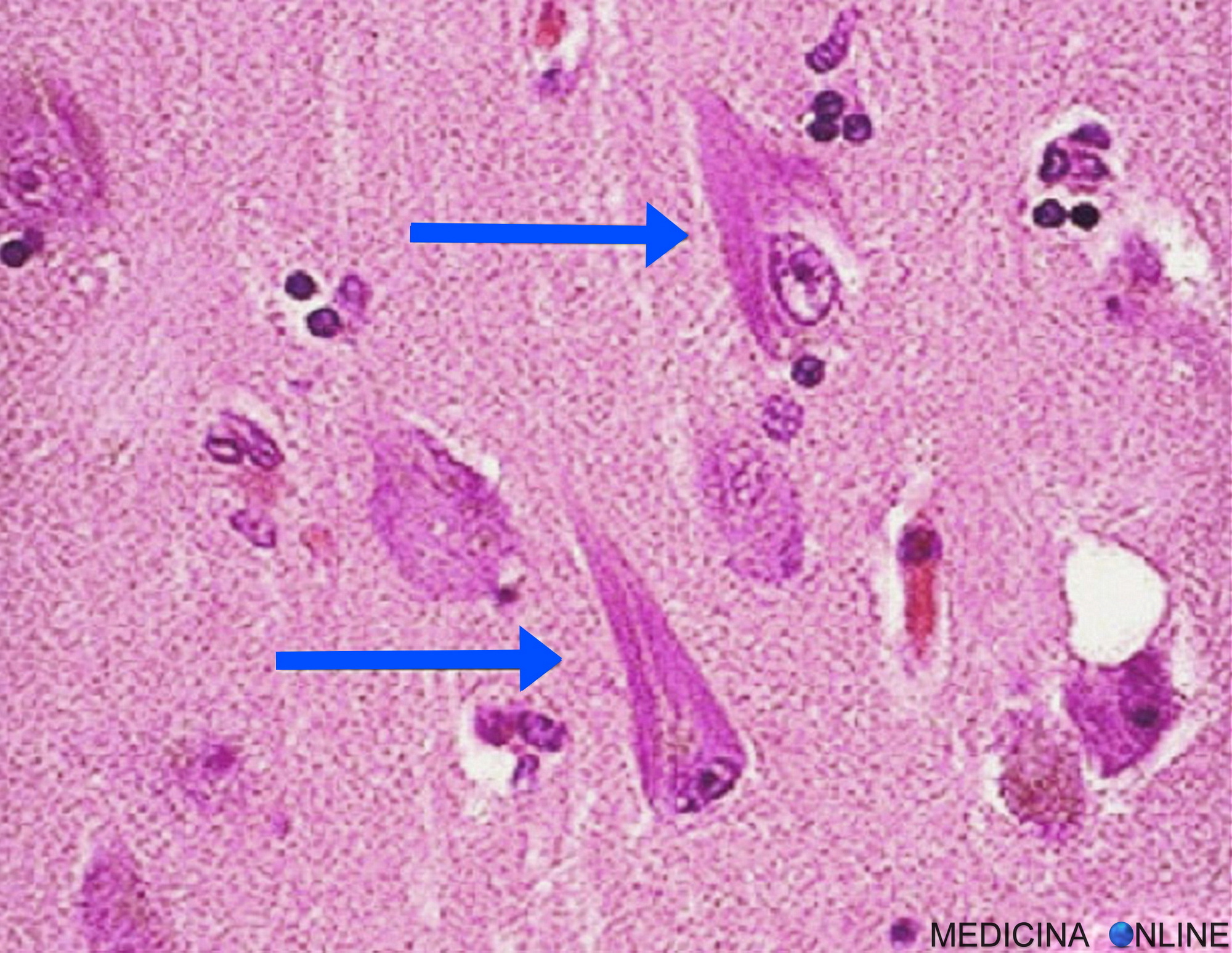 Corpi di Hirano: cosa sono e in quale malattie si trovano? | MEDICINA ...